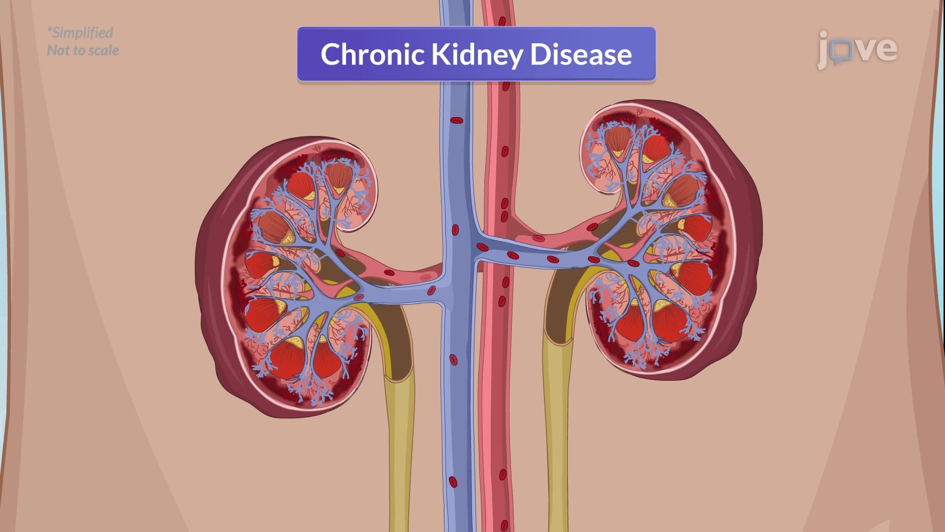 Video: Chronic Kidney Disease II: Clinical Manifestations