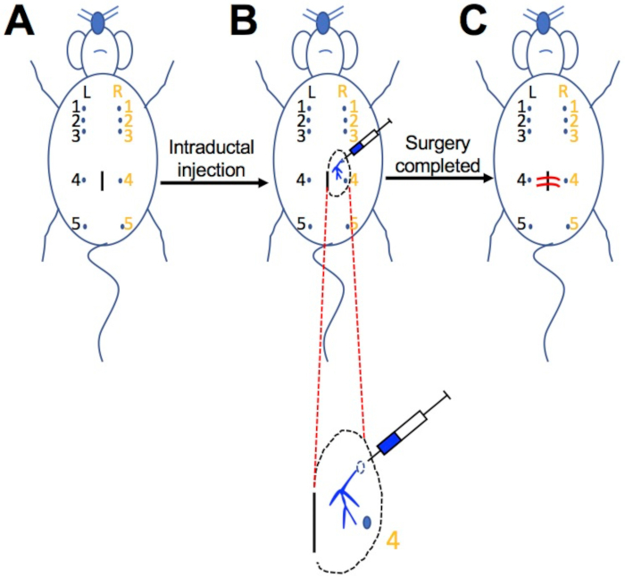 Intraductal Injection: Delivering Injection Mix into the Ducts of the ...
