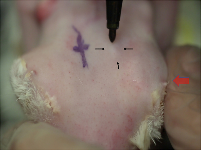 Performing Injection into Orbital Lobe of Superior Lacrimal Gland: A ...