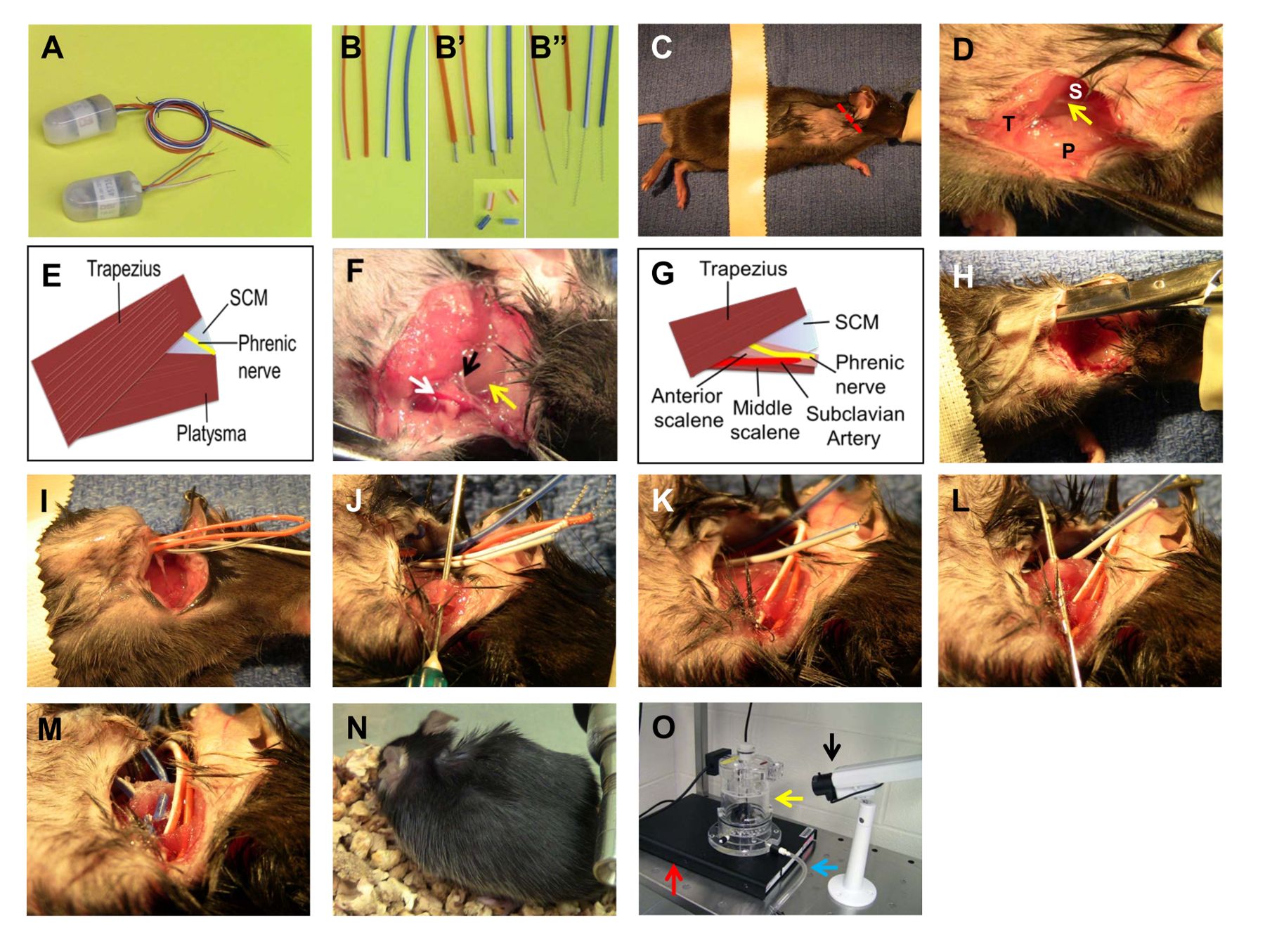 Simultaneous Plethysmography and Electromyography Recording in an ALS ...