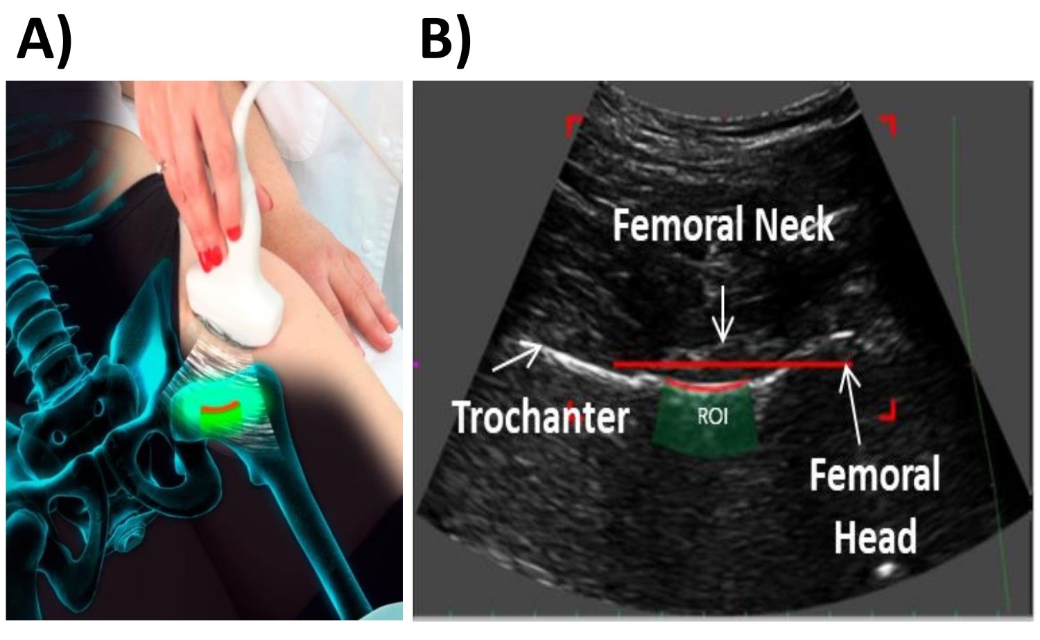 Assessing Bone Mineral Density Using Radiofrequency Echographic Multi ...