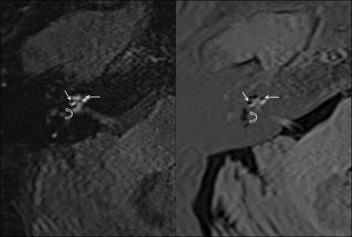 Video: Analiza MRI in vivo morfologii nerwu czaszkowego u pacjenta z ...