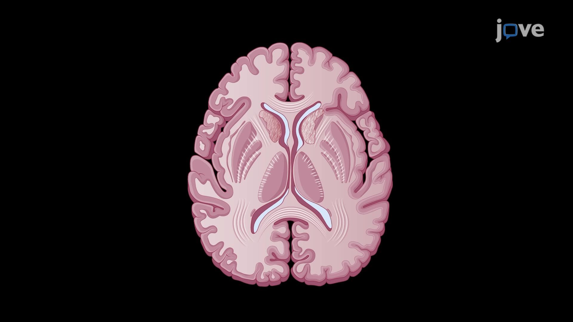 Video: Fluid-Attenuated Inversion Recovery Magnetic Resonance Imaging to Visualize Multiple ...