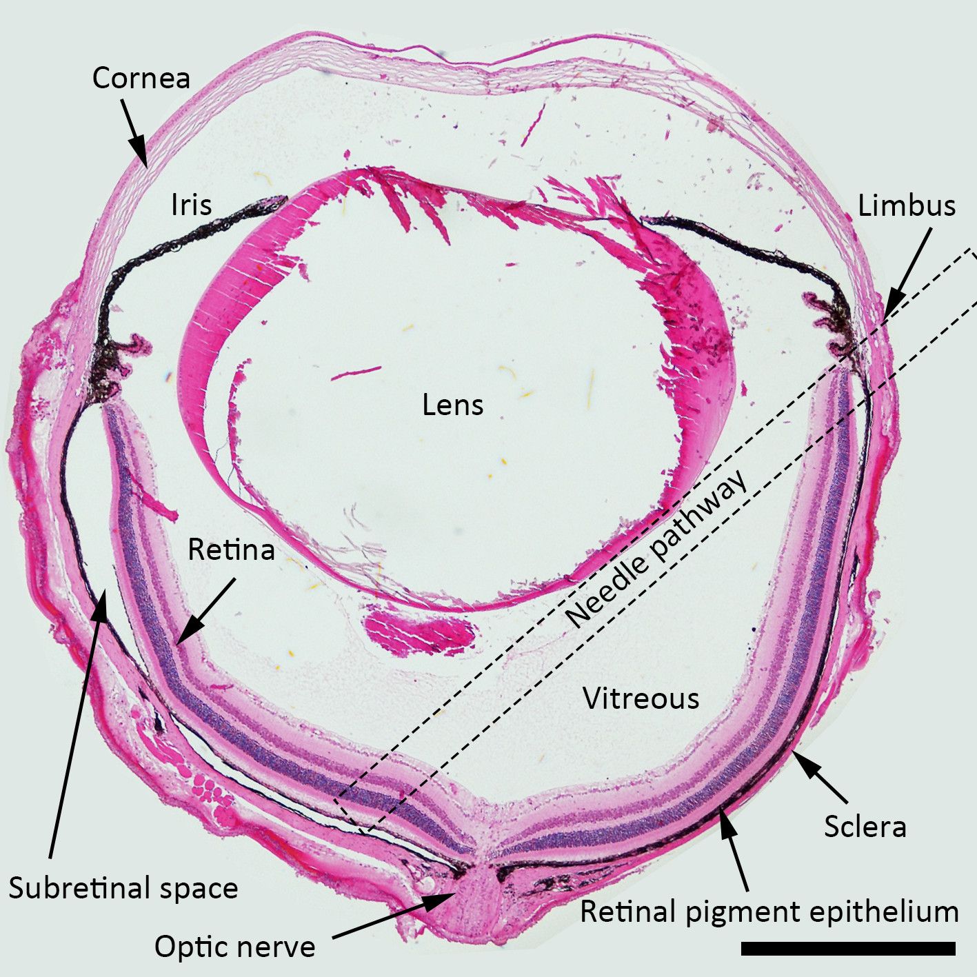 Subretinal Injection of Viral Vectors into the Retinal Pigment ...