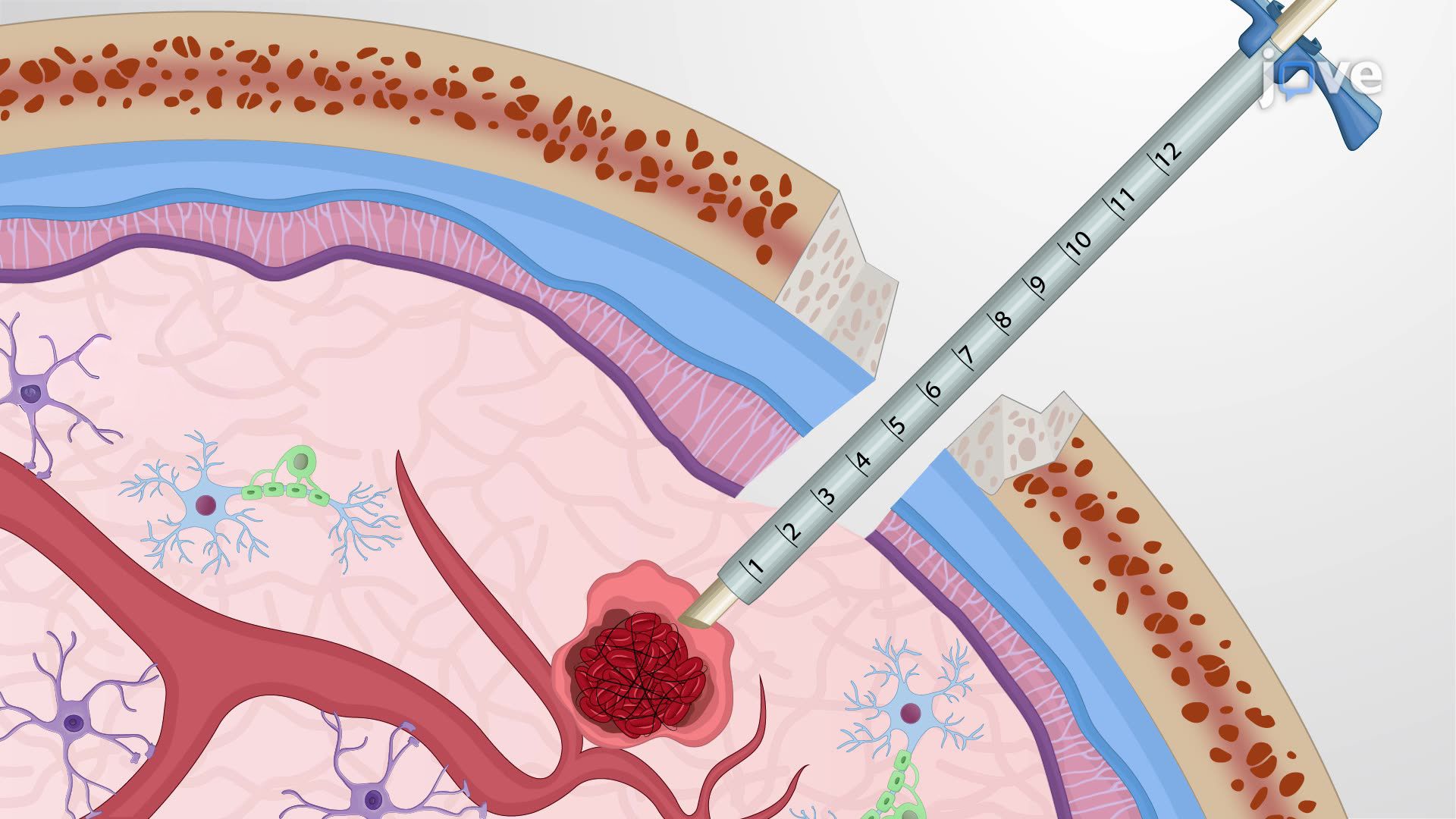Video: Minimally Invasive Endoscopic Procedure for Hematoma Removal from the Human Brain ...