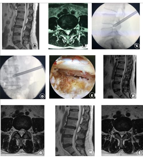 Full-Endoscopic Isolation Zone Technique for the Treatment of Lumbar ...