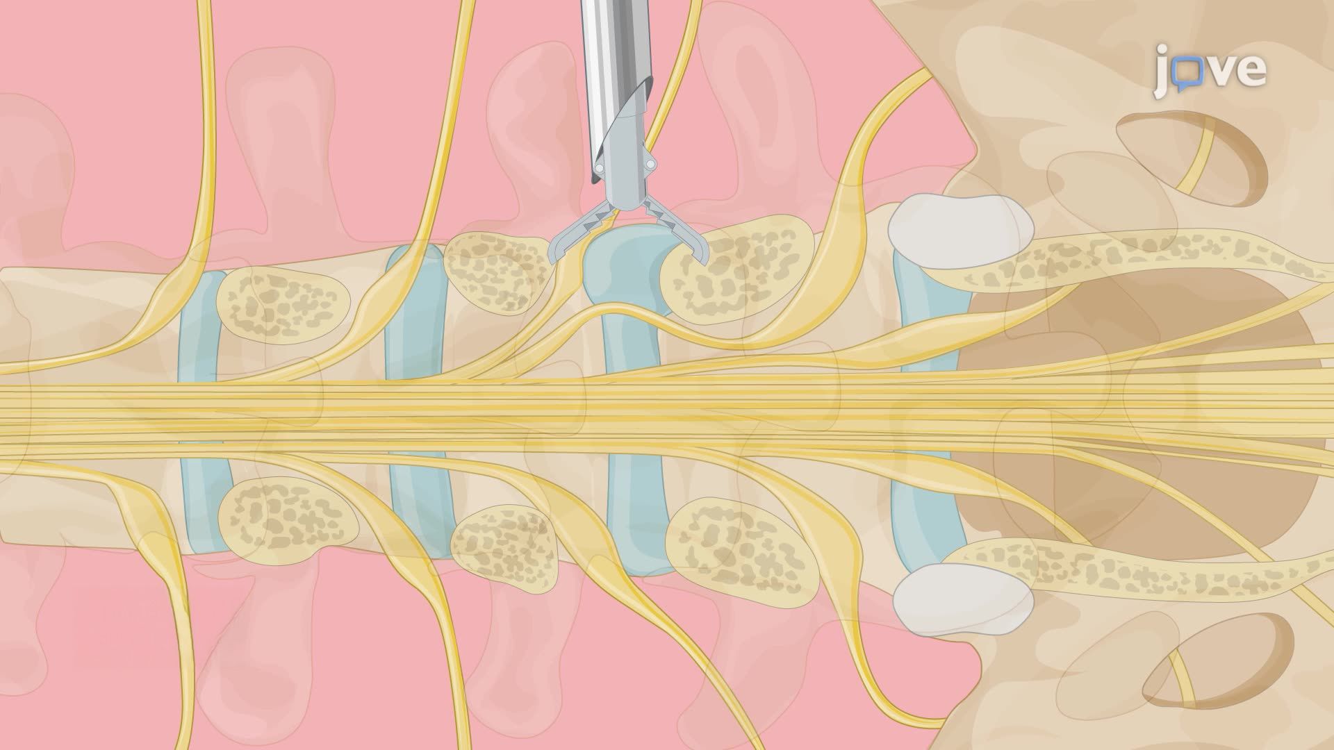 Full-Endoscopic Isolation Zone Technique for the Treatment of Lumbar ...