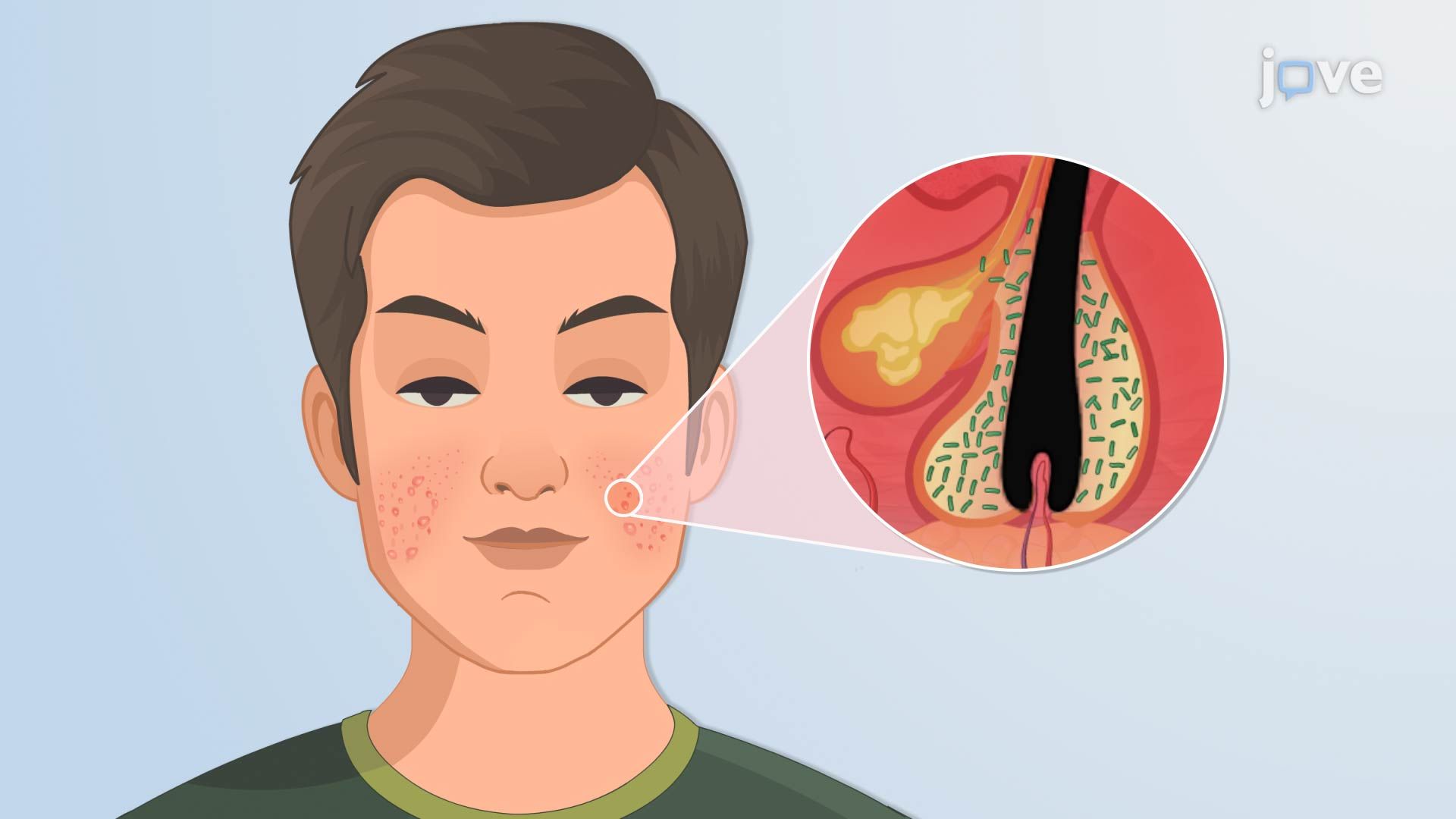 Serie: Acne Infection