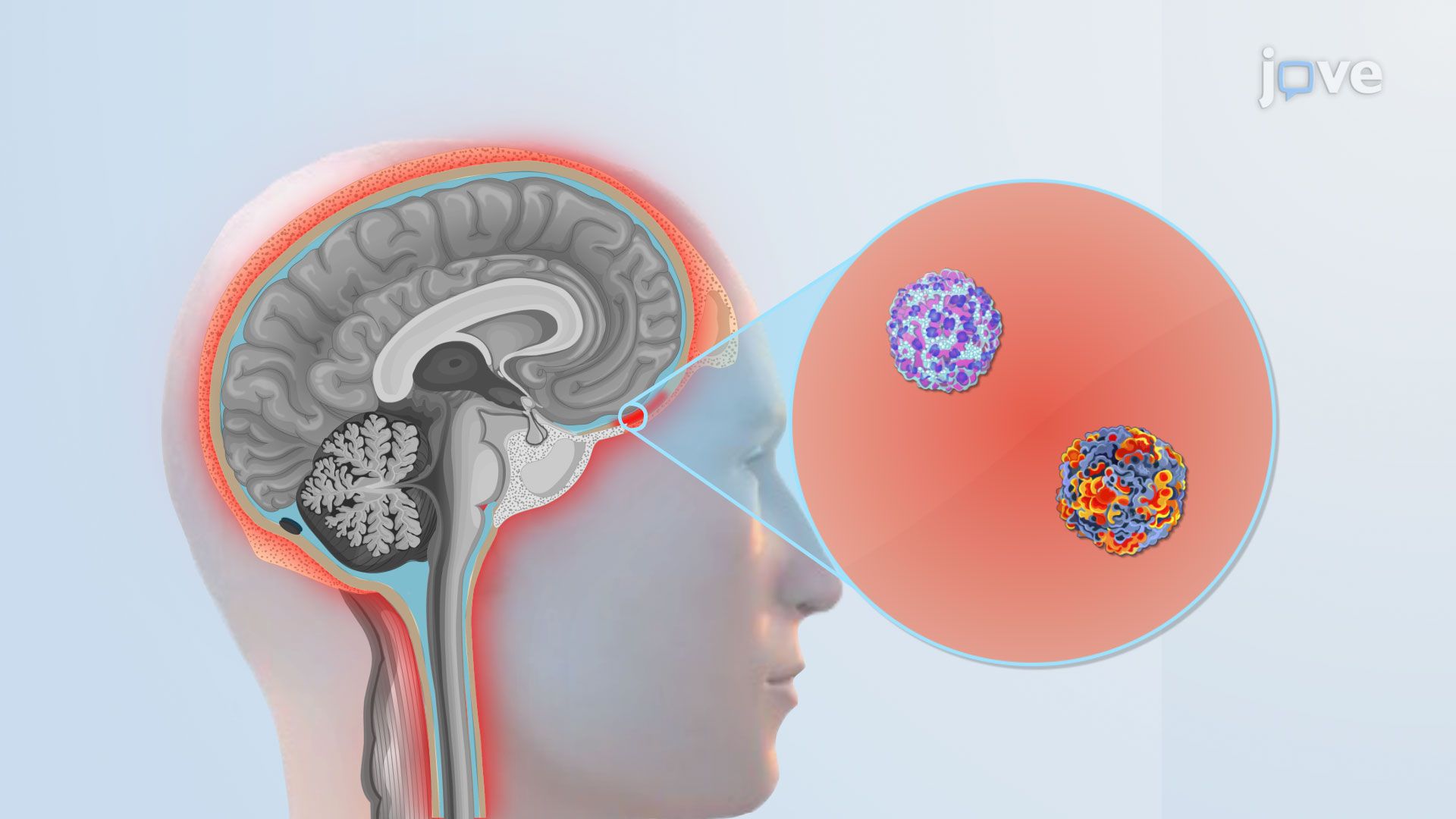 Vídeo: Viral Meningitis