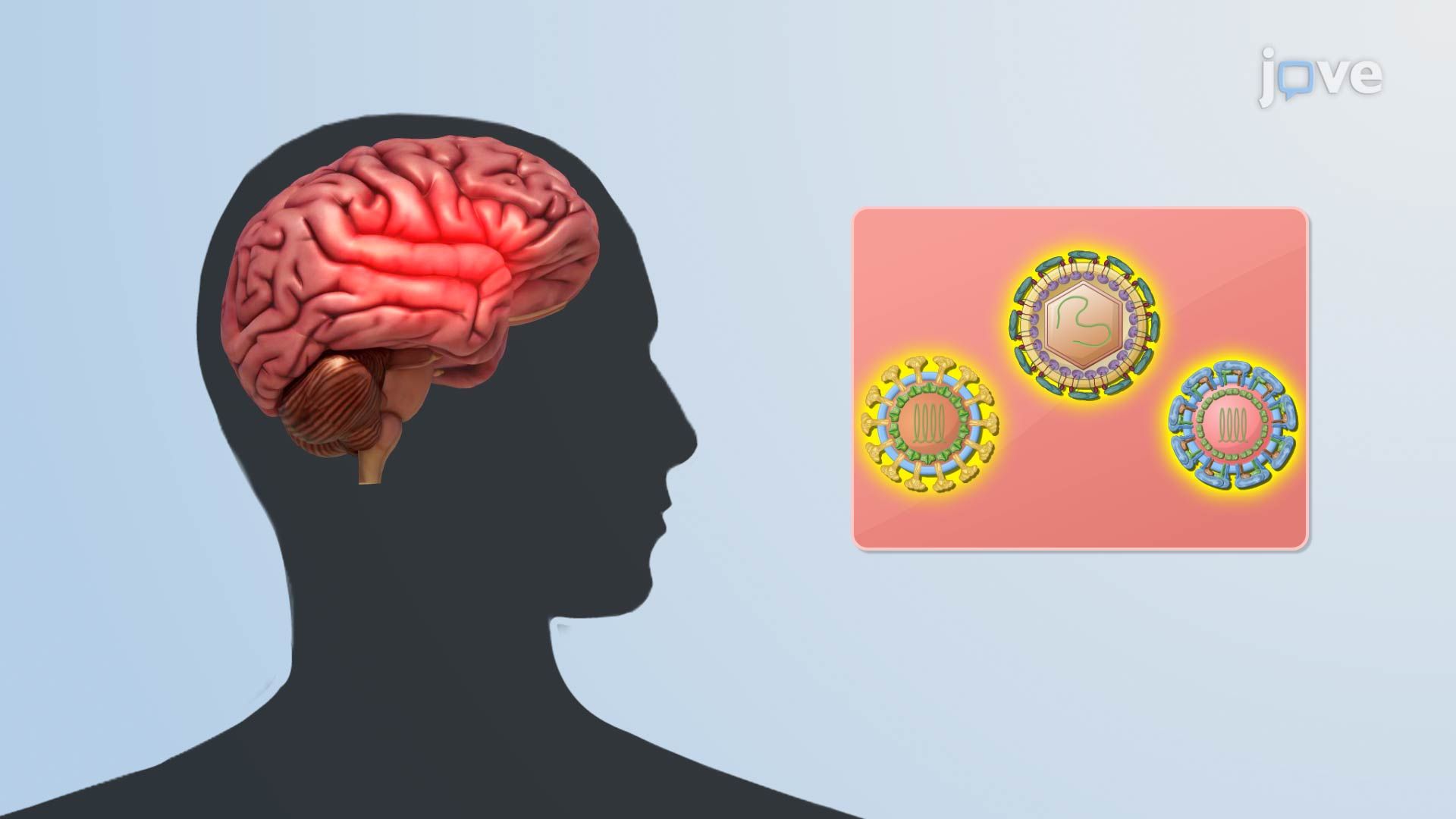 Video: Arboviral Encephalitis