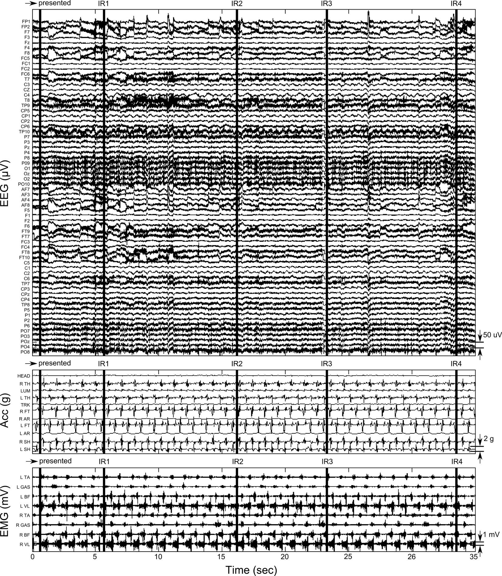 Simultaneous Scalp Electroencephalography EEG, Electromyography EMG ...