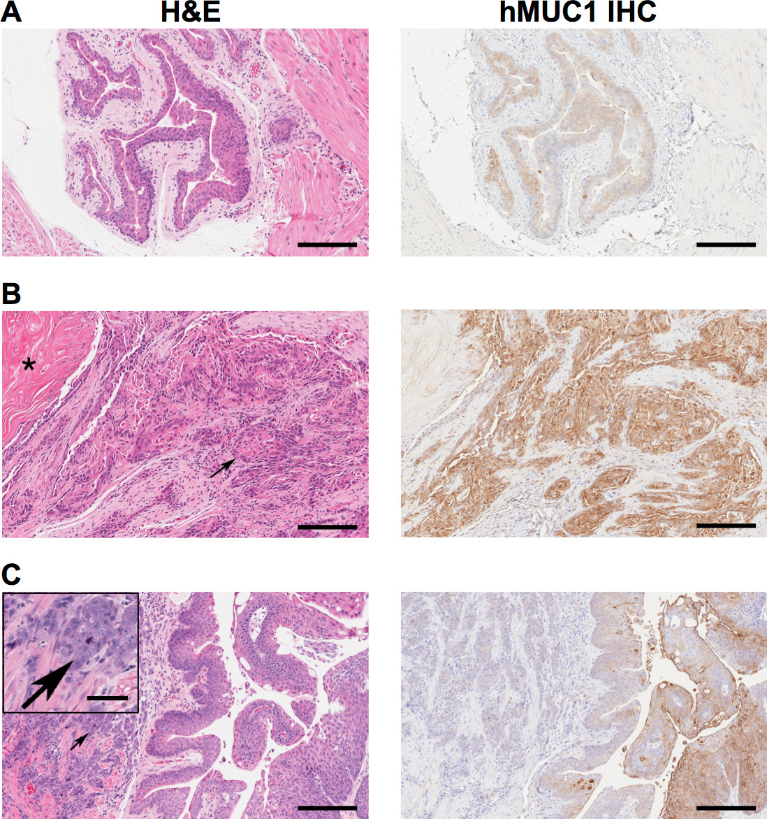 Induction of Invasive Transitional Cell Bladder Carcinoma in Immune ...