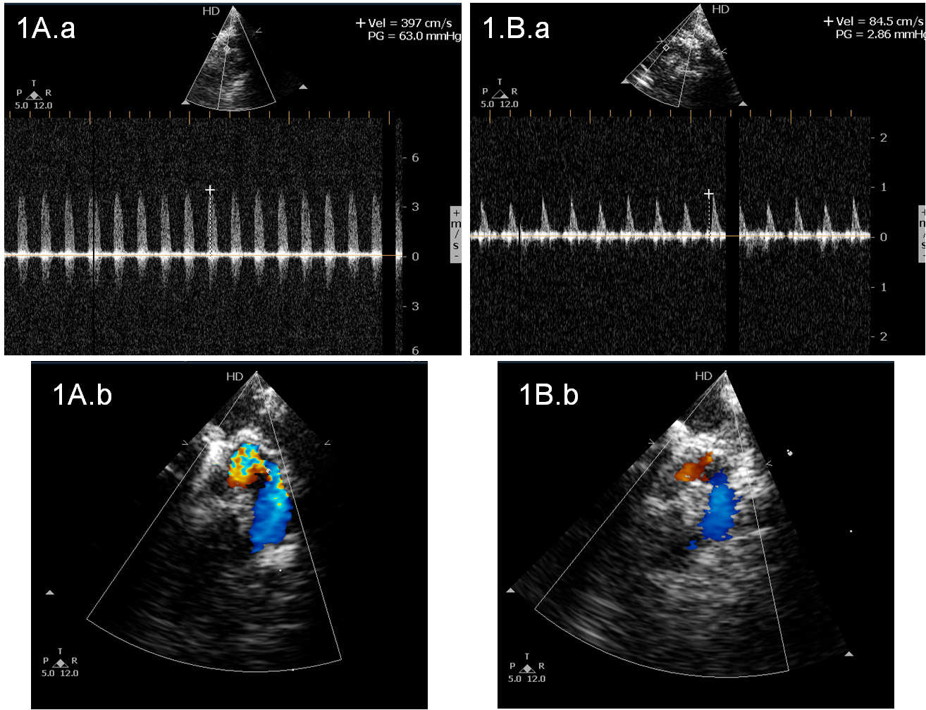 Ascending Aortic Constriction in Rats for Creation of Pressure Overload ...