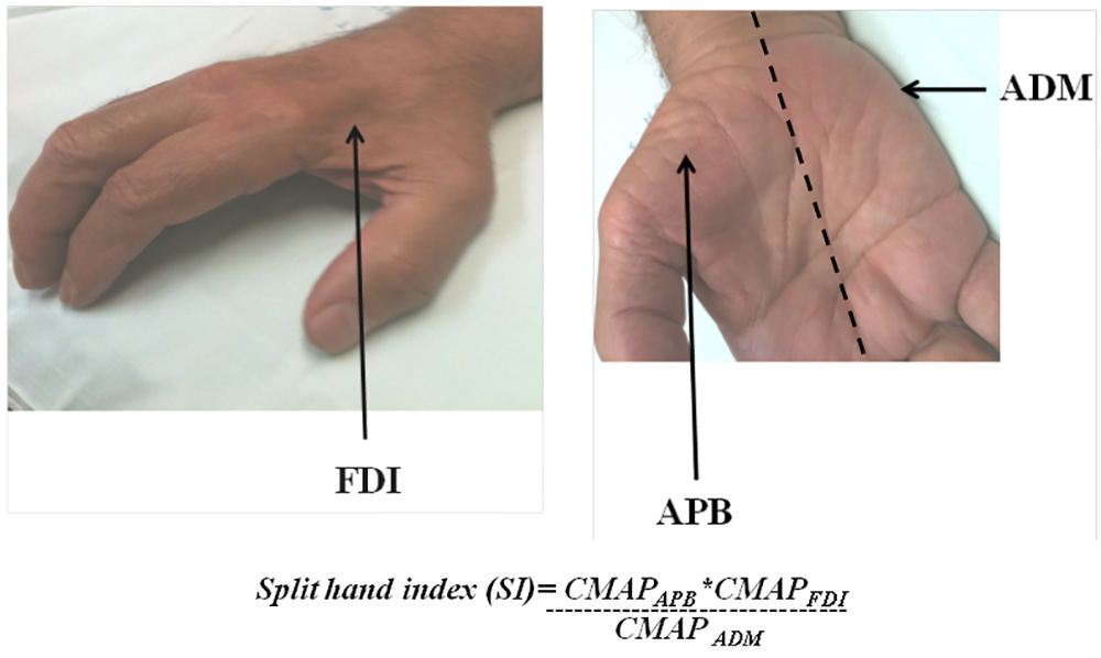 Utility of Dissociated Intrinsic Hand Muscle Atrophy in the Diagnosis ...