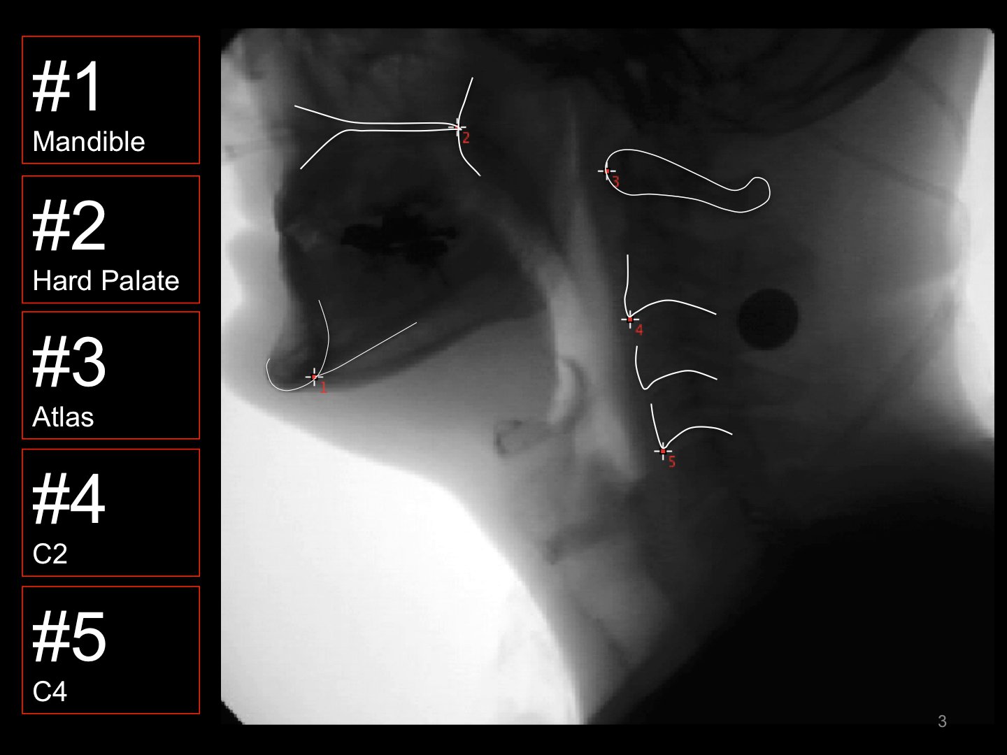 Coordinate Mapping of Hyolaryngeal Mechanics in Swallowing | Protocol
