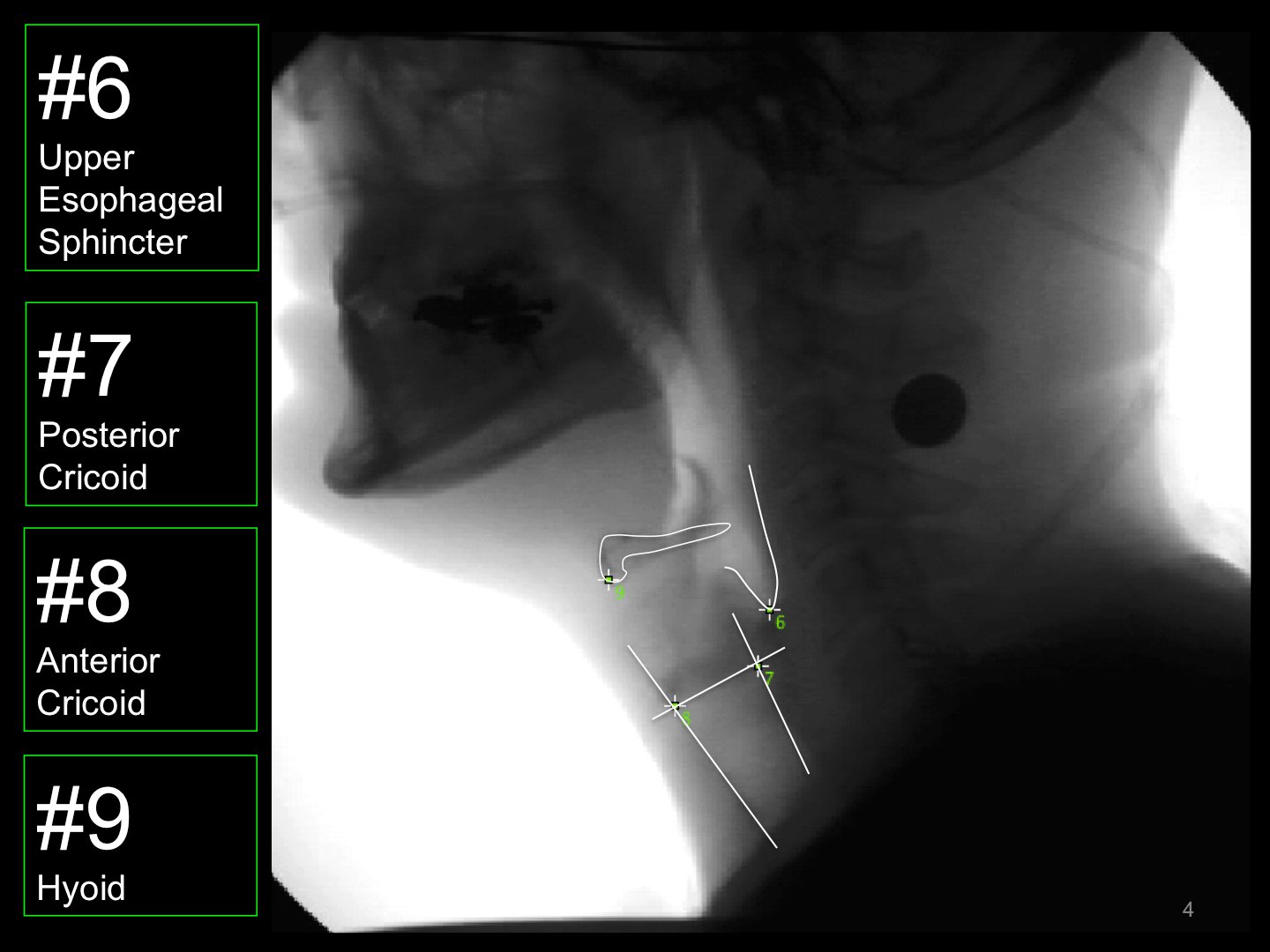 Upper Esophageal Sphincter Dysfunction Cricopharyngeal dysfunction (CPD ...