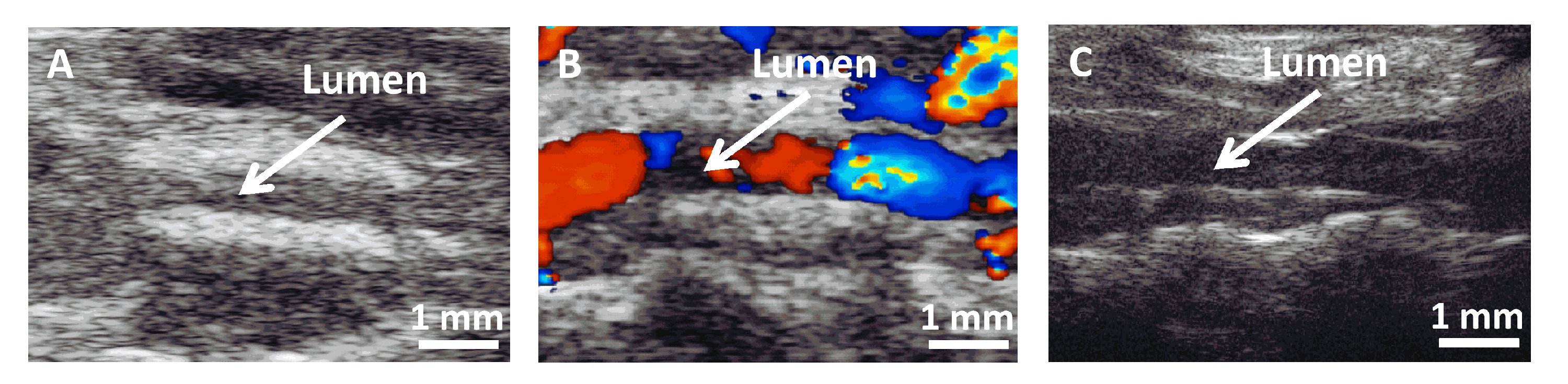 Implantation of Inferior Vena Cava Interposition Graft in Mouse Model ...