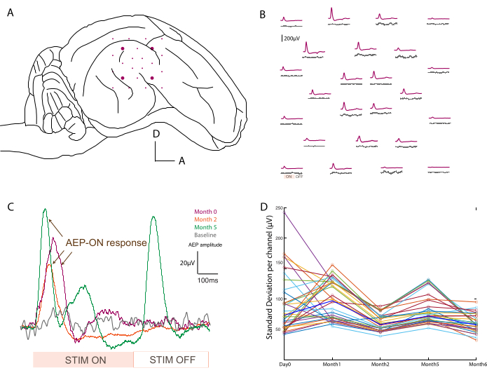 Subdural Soft Electrocorticography ECoG Array Implantation and Long ...