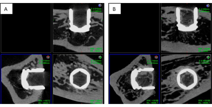 Surgical Bone Implantation Technique for Rat Tibia Models of Diabetes ...